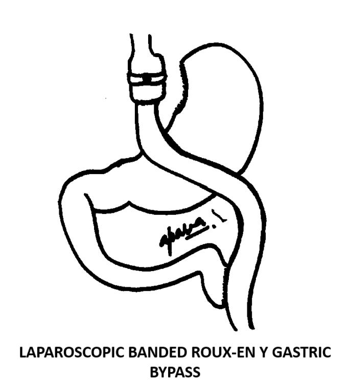 Laparoscopic Banded Roux-en Y Gastric Bypass (BRYGB) Mumbai, India - Dr ...