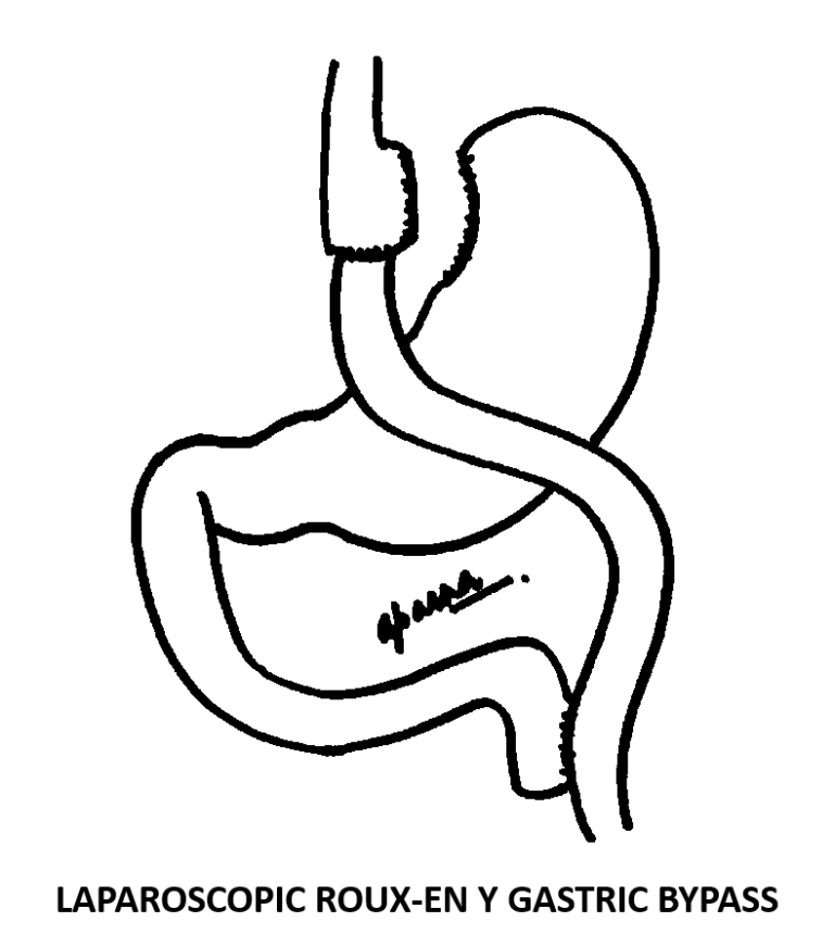 Laparoscopic Roux-en Y Gastric Bypass (RYGB) Mumbai, India - Dr. Aparna ...